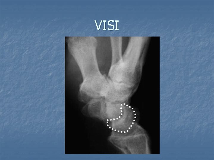Fractures and dislocations of the wrist Dr Ihab