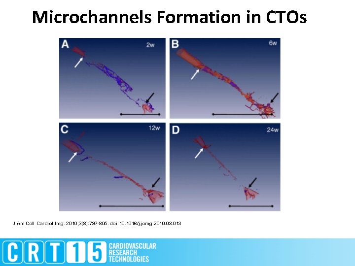 Crossing SFA CTO with a Wire William Bachinsky