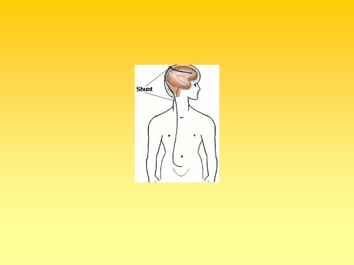 Neural tube defect Encephalocele Meningocele Meylomeningocele Spina bifida