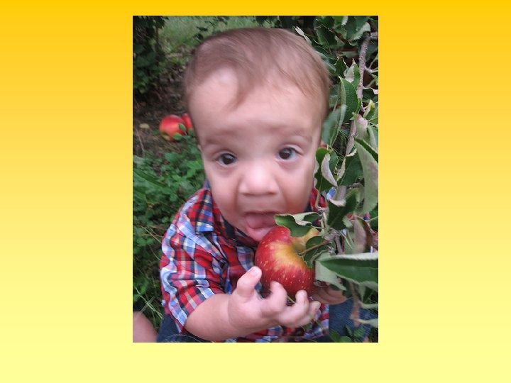 Neural tube defect Encephalocele Meningocele Meylomeningocele Spina bifida