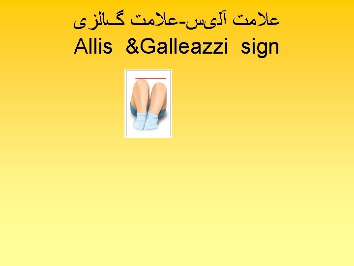 Neural tube defect Encephalocele Meningocele Meylomeningocele Spina bifida