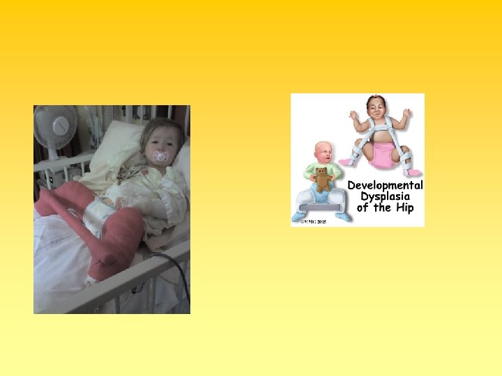 Neural tube defect Encephalocele Meningocele Meylomeningocele Spina bifida