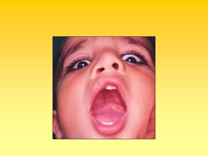 Neural tube defect Encephalocele Meningocele Meylomeningocele Spina bifida