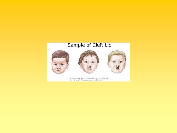 Neural tube defect Encephalocele Meningocele Meylomeningocele Spina bifida