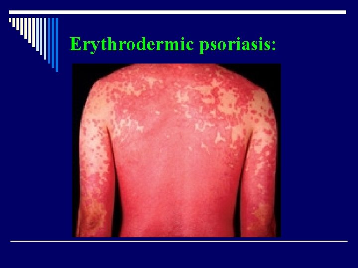 Papulosquamous diseases Dr MOHAMED NASR Lecturer Of Dermatology