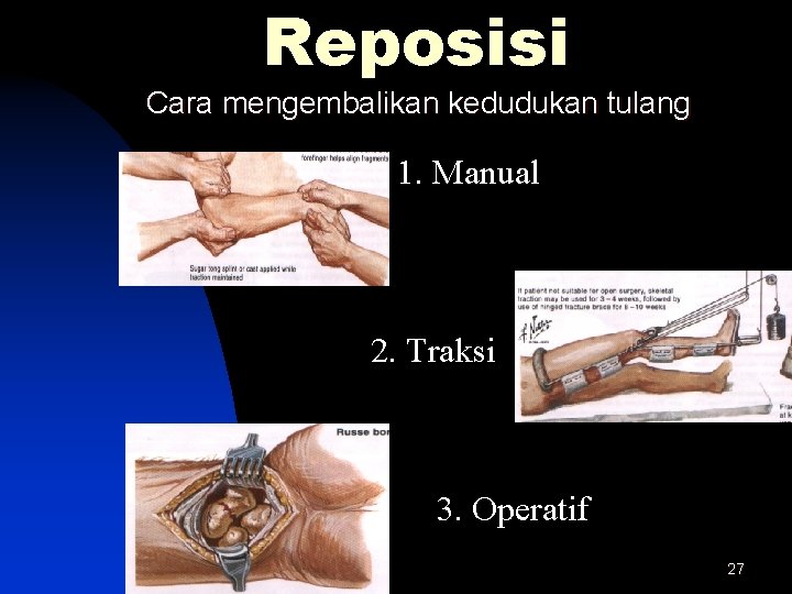 KONSEP FRAKTUR Ns M Shodikin M Kep Sp