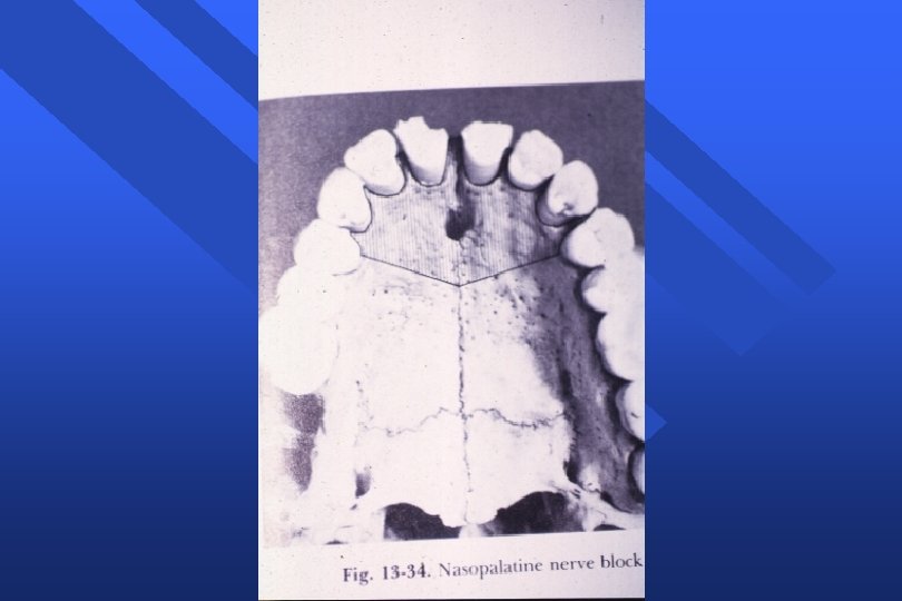 PALATAL ANESTHESIA Greater Palatine Nerve Block Anterior Palatine