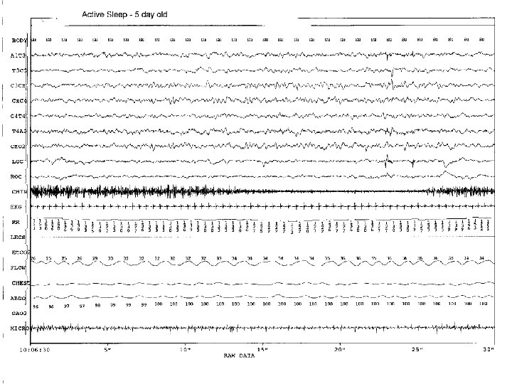 PSG Scoring for the Pediatric Patient Jennifer Chen