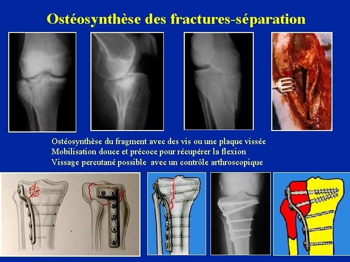 Fractures de lextrmit proximale du tibia Les fractures