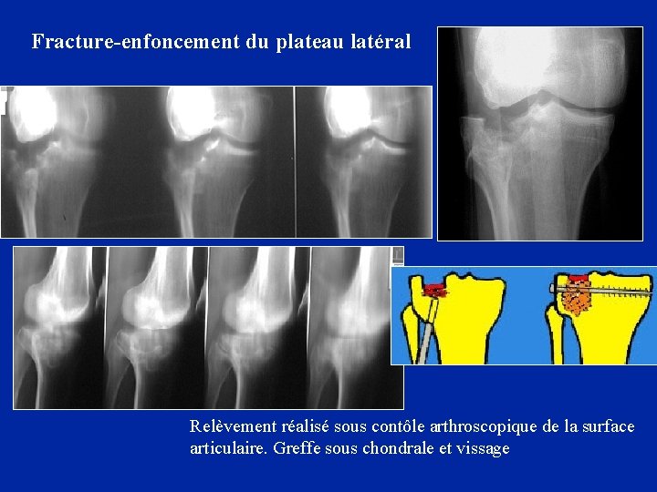 Fractures de lextrmit proximale du tibia Les fractures