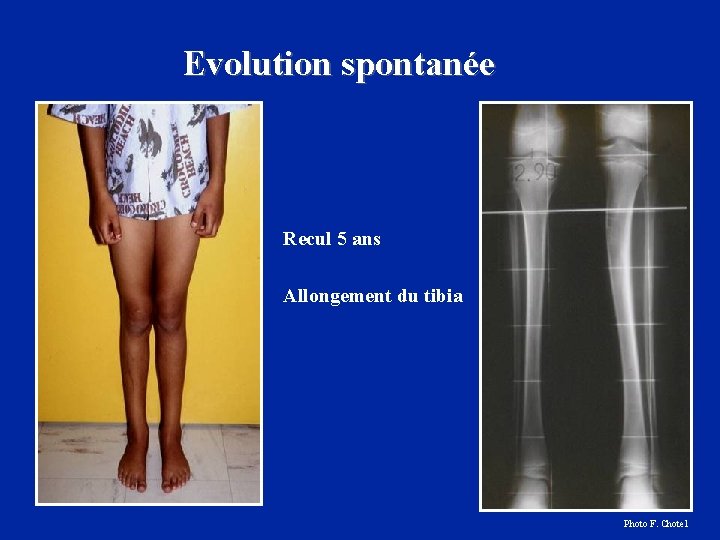 Fractures de lextrmit proximale du tibia Les fractures