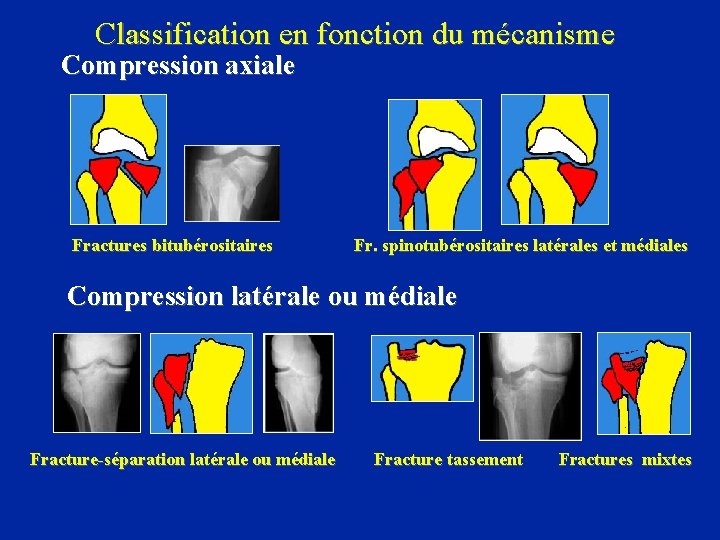 Fractures de lextrmit proximale du tibia Les fractures