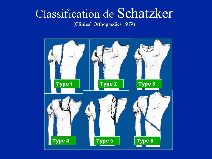 Fractures de lextrmit proximale du tibia Les fractures