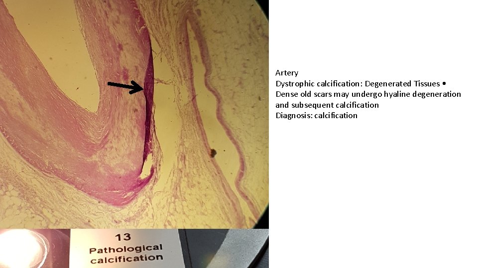 Artery Dystrophic calcification Degenerated Tissues Dense old scars