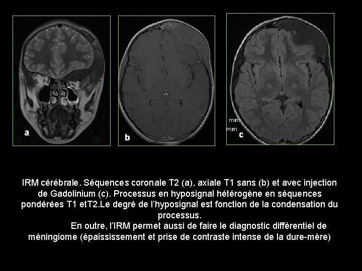 IMAGING FEATURES OF NONTUMOR EXOPHTALMOS IMAGERIE DES EXOPHTALMIES