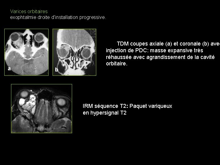 IMAGING FEATURES OF NONTUMOR EXOPHTALMOS IMAGERIE DES EXOPHTALMIES