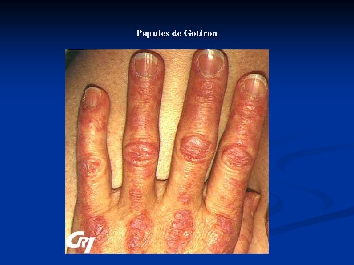 La polymyosite Le cas dun patient n Mr