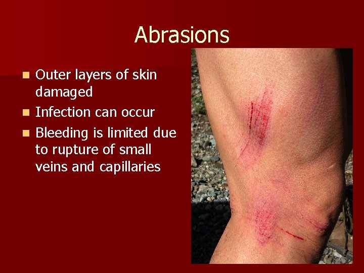 Classification of Wounds Sports Medicine I Wound Management