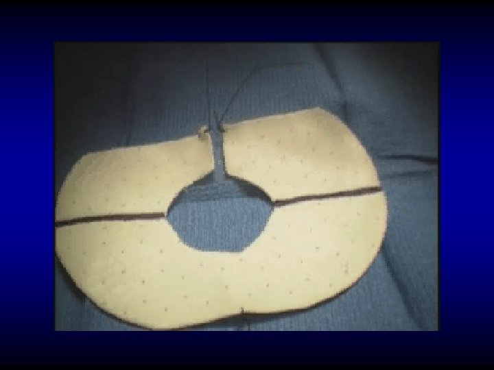 The Use of Mesh Prosthesis for Hiatal Hernia