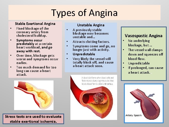 Stress Testing and Heart Disease Symptoms Janet V