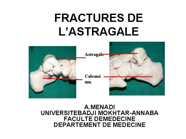 FRACTURES DE LASTRAGALE 3 2 Astragale Calcan um