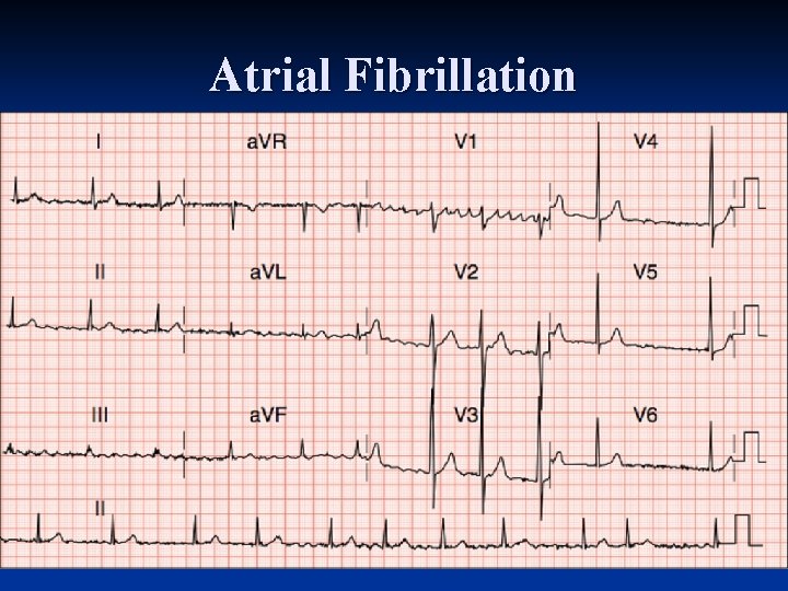 ECG 101 Narrow Complex Tachycardia Scott E Ewing