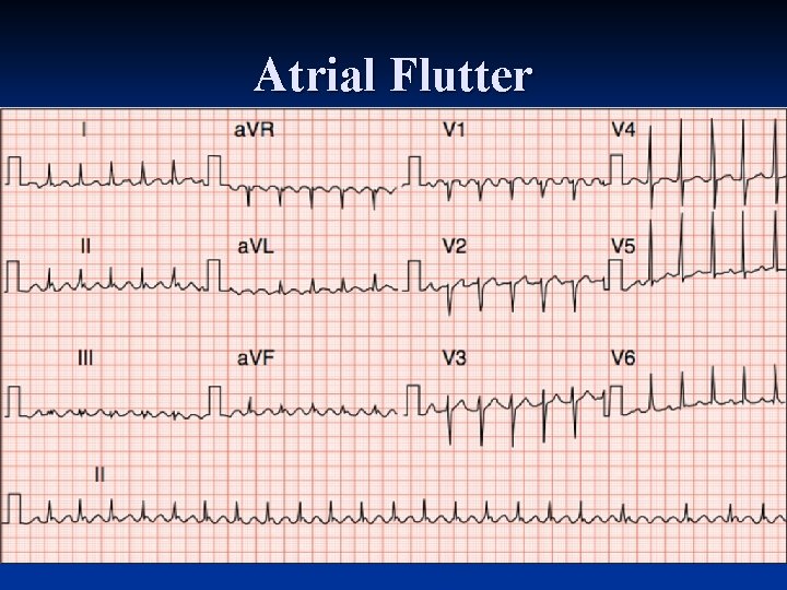 ECG 101 Narrow Complex Tachycardia Scott E Ewing