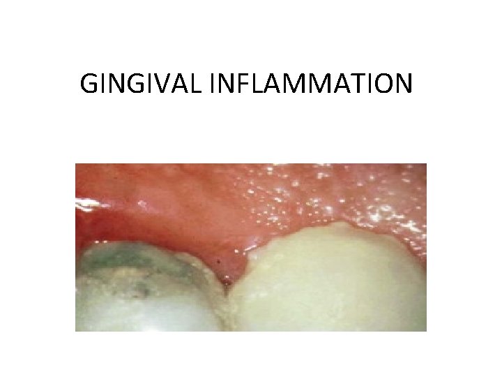 GINGIVAL INFLAMMATION INTRODUCTION Stage I GingivitisInitial lesion Stage