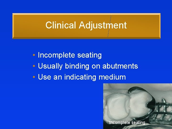 Removable Partial Denture Framework Adjustment Rudd Kuebker 75