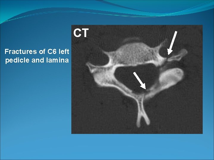 Introduction to Neuroimaging SPINE Ayegl Sarslmaz MD Radiology