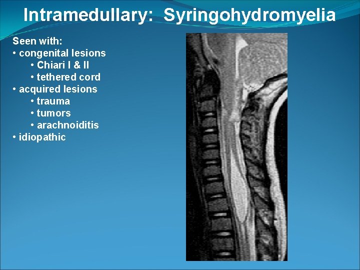 Introduction to Neuroimaging SPINE Ayegl Sarslmaz MD Radiology