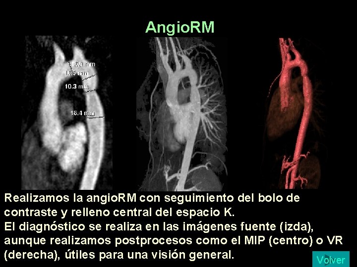 Coartacin Artica Estudio Morfolgico y Funcional con Resonancia