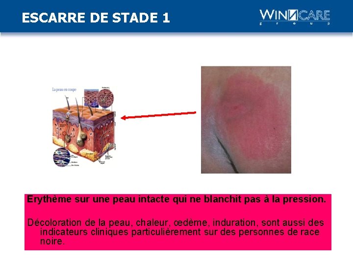 La physiopathologie des Escarres Remerciements aux socits savantes