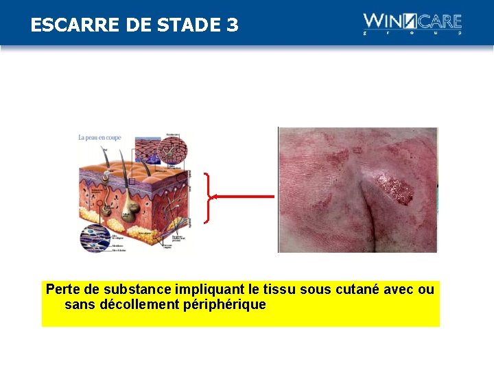 La physiopathologie des Escarres Remerciements aux socits savantes