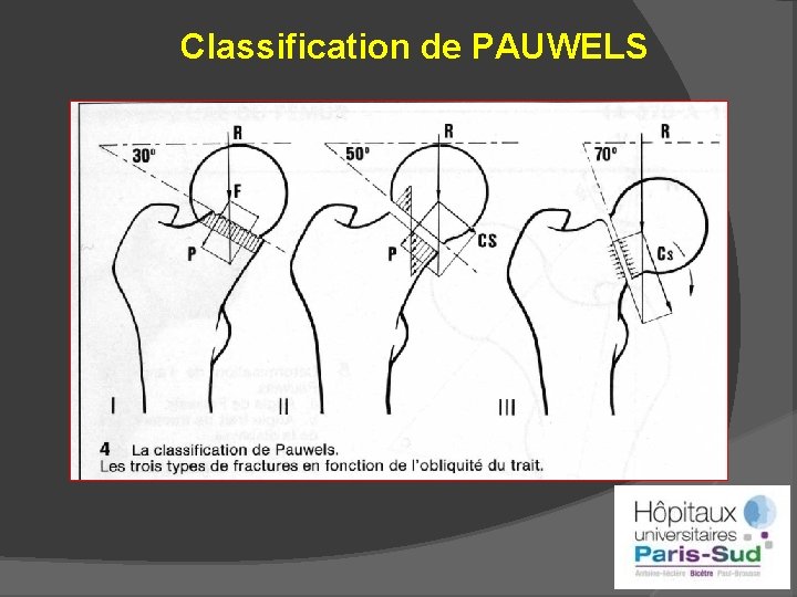 TRAUMATISME DE LA HANCHE PRINCIPES DE LA PRISE