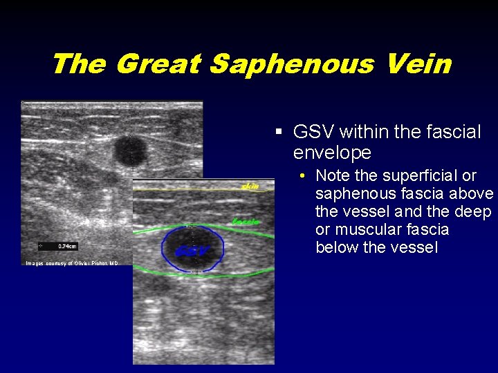 Venous Ablation Therapy When and How Keith M