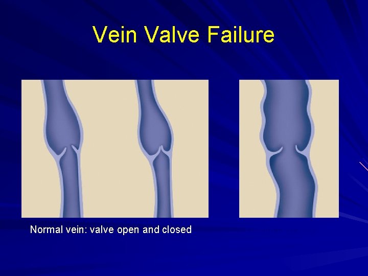 Venous Ablation Therapy When and How Keith M