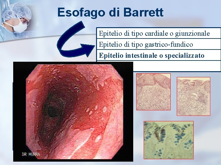 TUMORI DELL ESOFAGO TUMORI DELLESOFAGO BENIGNI Epiteliali Papilloma