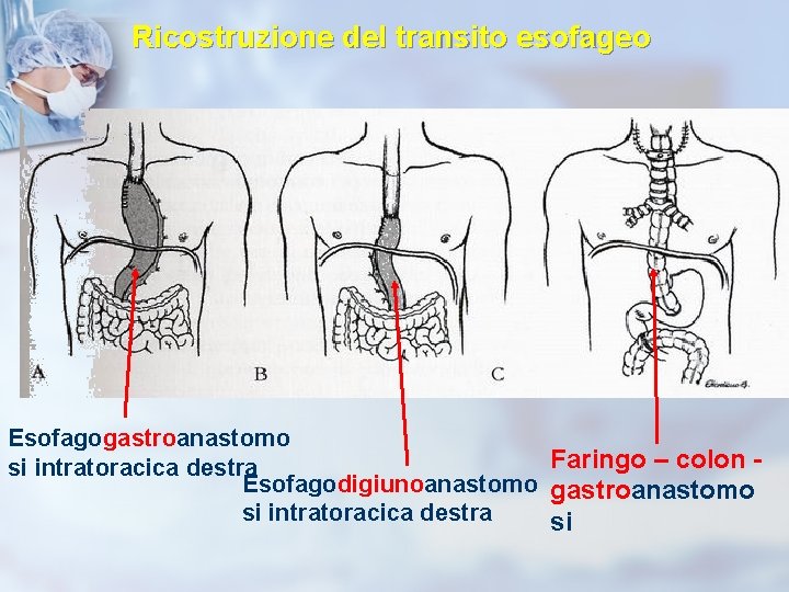 TUMORI DELL ESOFAGO TUMORI DELLESOFAGO BENIGNI Epiteliali Papilloma