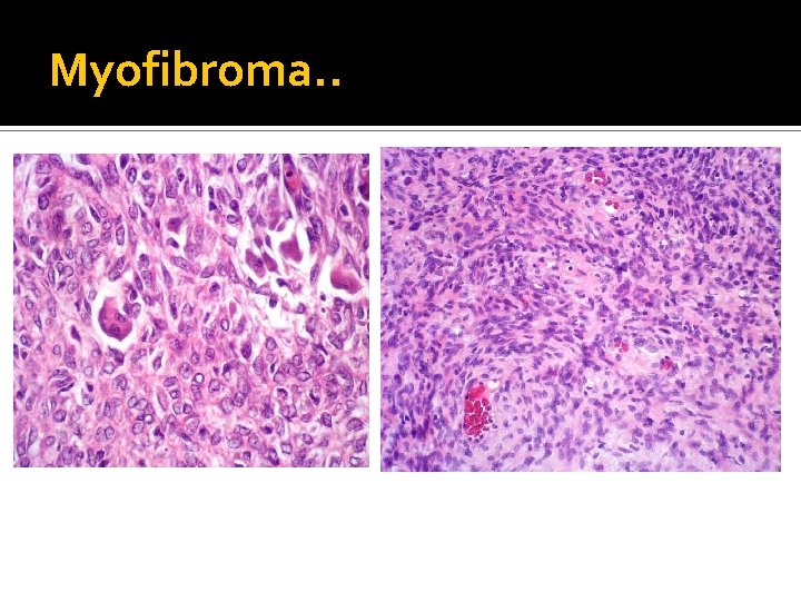 BENIGN AND MALIGNANT CONNECTIVE TISSUE TUMOURS FIBROMA MOST