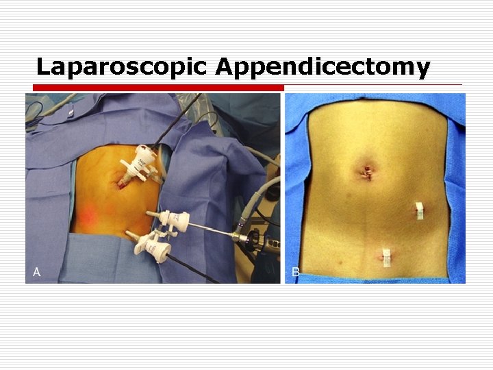 Appendicitis in children A review of the current