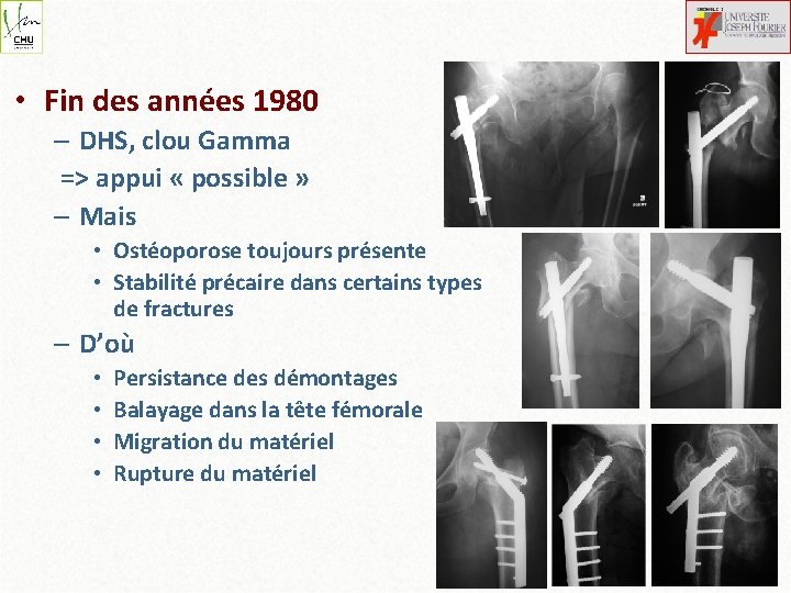 Prothses de hanche dans les fractures instables du