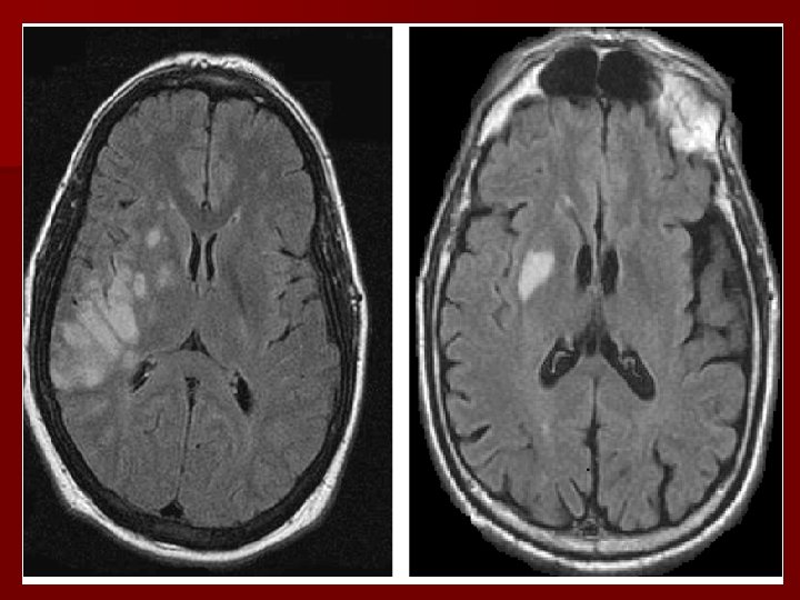 Hemibalismo Dr Rodrigo Snchez R Becado Neurologa Hospital