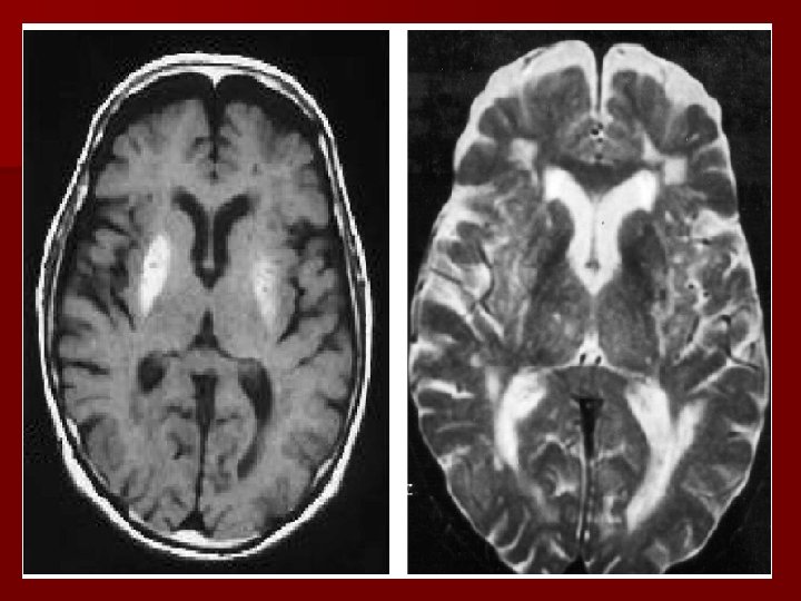 Hemibalismo Dr Rodrigo Snchez R Becado Neurologa Hospital