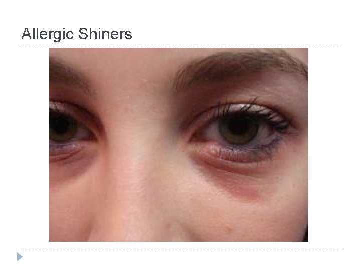 Allergic Rhinitis Dr Dinesh Kumar Assistant Professor ENT