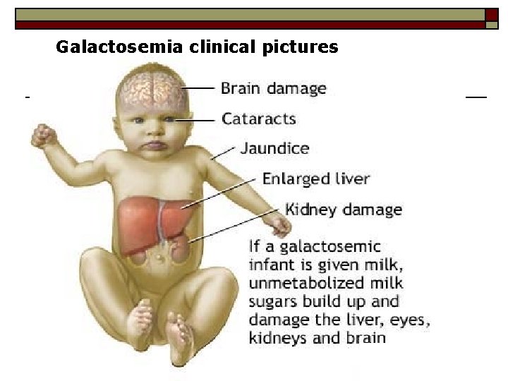 Galactosemia screening why when how Clinical Childrens Hospital