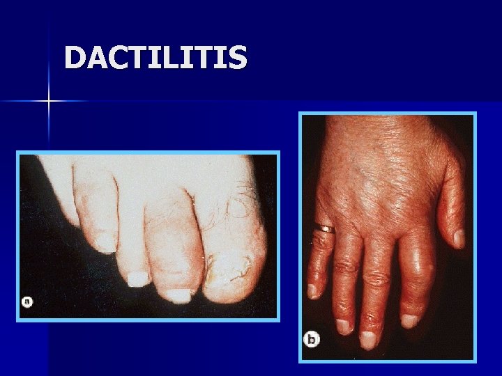 ESPONDILOARTROPATIAS SERONEGATIVAS ESPONDILOARTROPATIAS SERONEGATIVAS ...