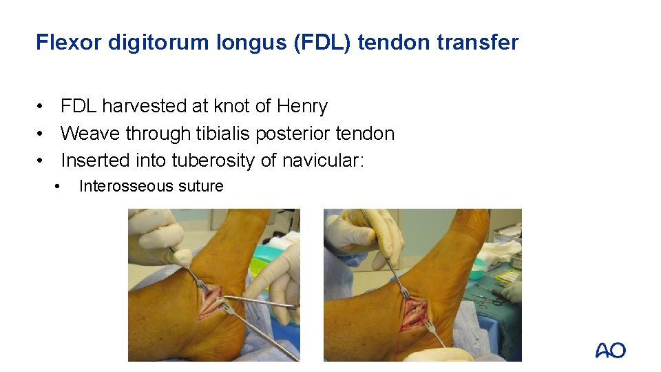 Flatfoot deformity Case for small group discussion AOTraumaFoot