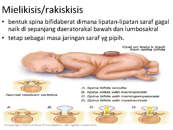 SPINA BIFIDA Ayling Sanjaya Fakultas Kedokteran Universitas Wijaya