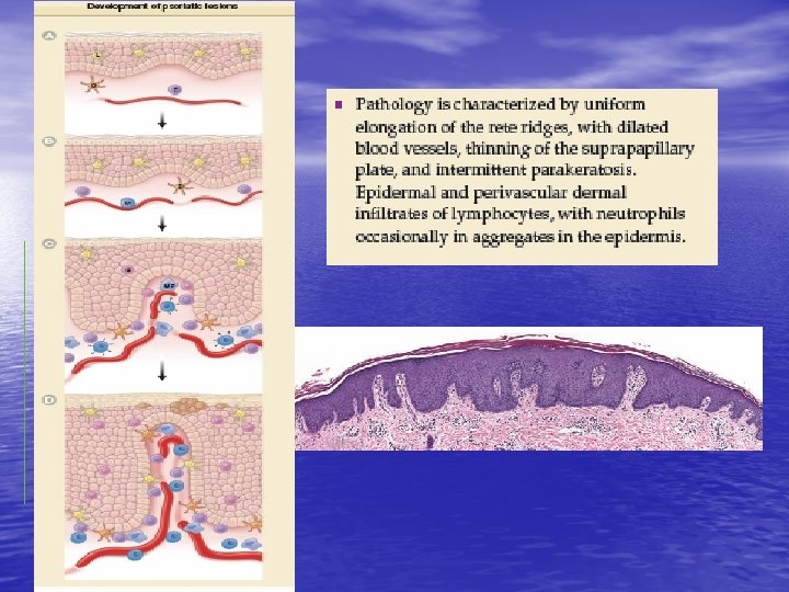 PAPULOSQUAMOUS DISEASES Psoriasis Lichen planus Lichen nitidus Pityriasis